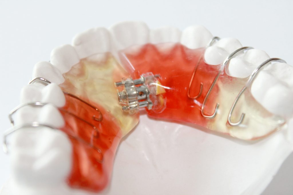 Zahnspangen – KFO Roloff