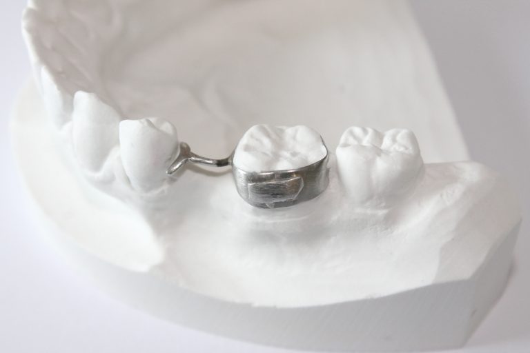 Zahnspangen – KFO Roloff